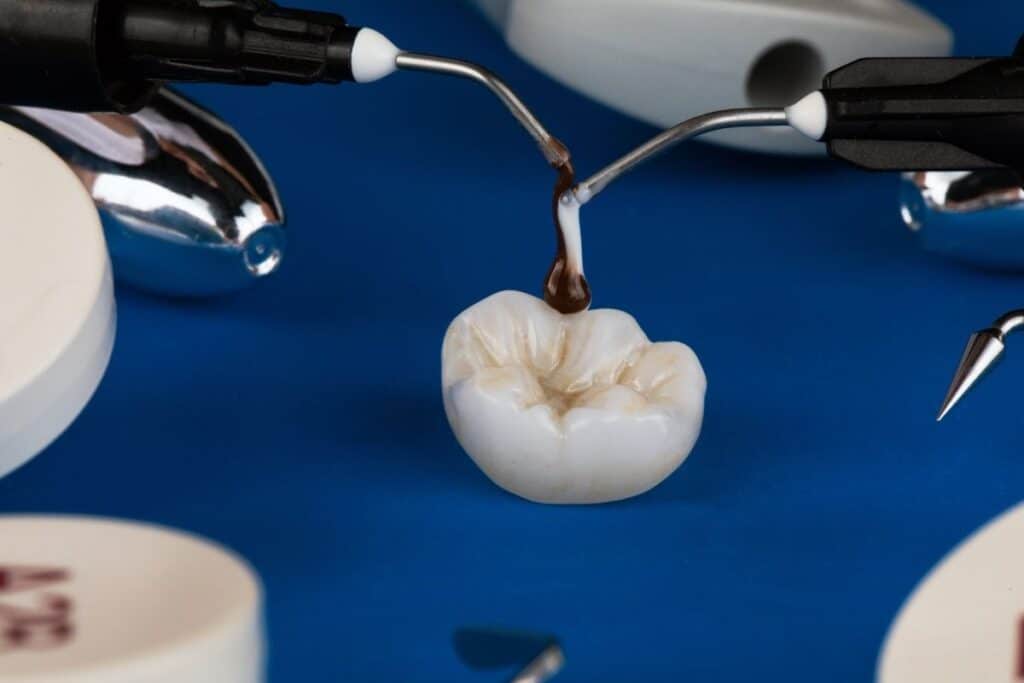 Root Canal Through Crown: How It Is Performed?