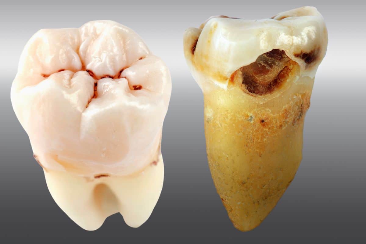 Rotten Wisdom Tooth: A Serious Health Risk