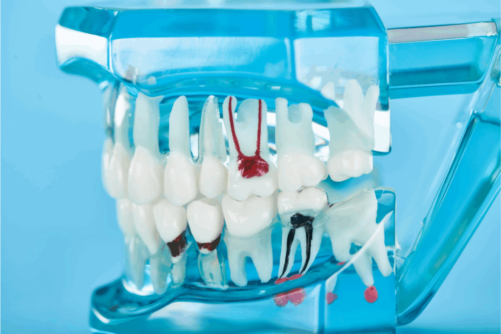 How Long To Wait to Smoke After A Root Canal